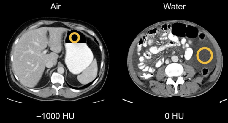 Abdominal CT: Attenuation • LITFL • Radiology library