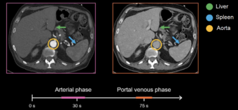 Abdominal CT: Phases • LITFL • Radiology library