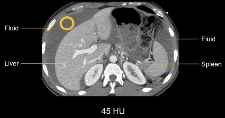 Abdominal CT: Attenuation • LITFL • Radiology library