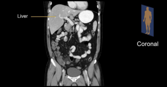 Abdominal CT: Planes • LITFL • Radiology library