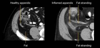 Abdominal CT: Common Terms • LITFL • Radiology library