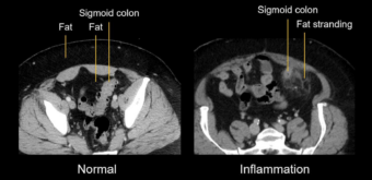 Abdominal CT: Common Terms • LITFL • Radiology library
