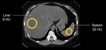 Abdominal CT: Attenuation • LITFL • Radiology library