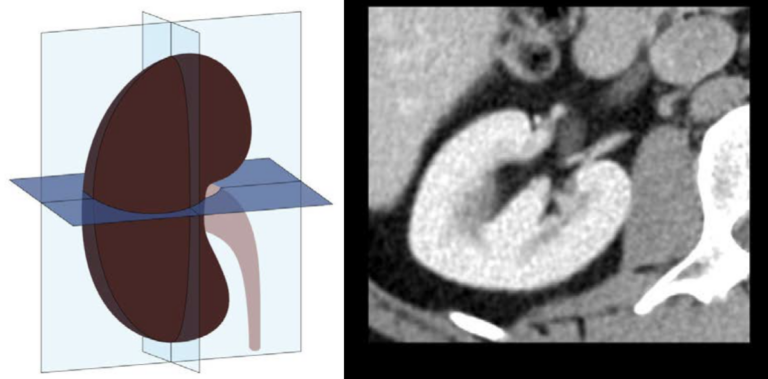 Abdominal CT: Planes • LITFL • Radiology library Abdominal CT: Planes • LITFL • Radiology library