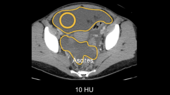 Abdominal CT: Attenuation • LITFL • Radiology library