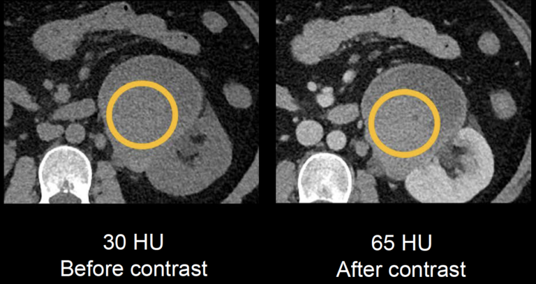Abdominal CT: Attenuation • LITFL • Radiology library