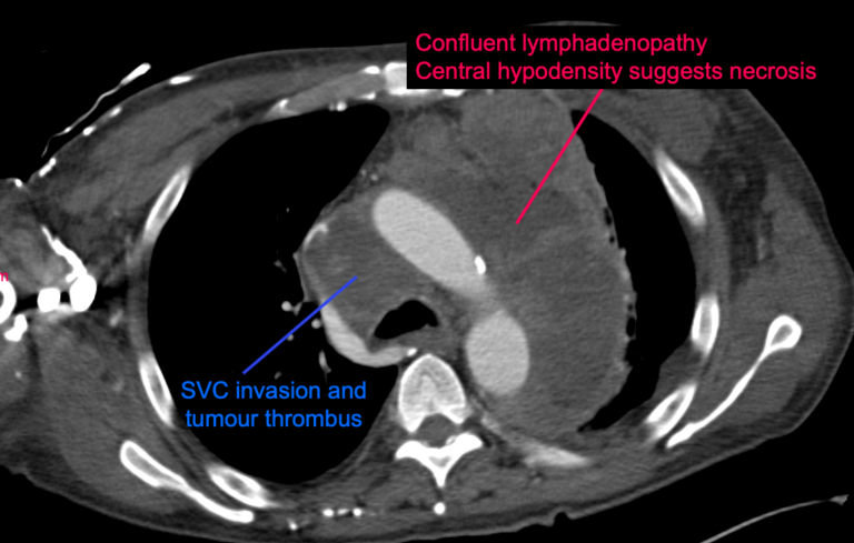 CT Case 038 • LITFL • CT scan interpretation