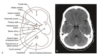 CT Case 004 • LITFL • CT scan interpretation
