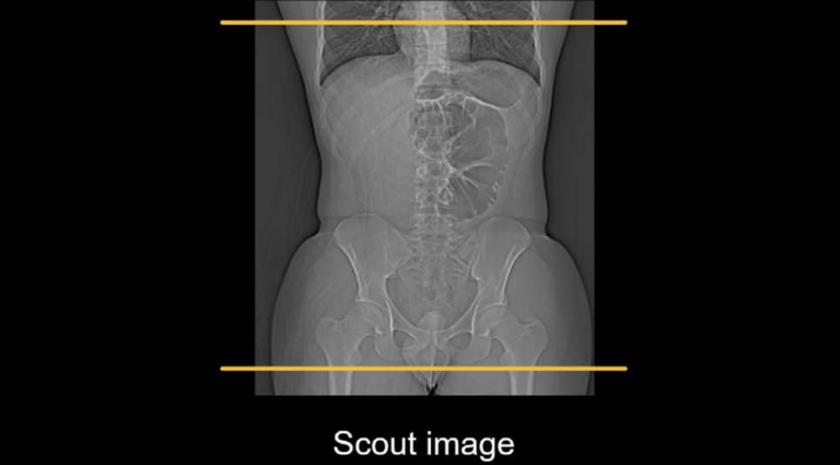Abdominal CT: Planes • LITFL • Radiology library
