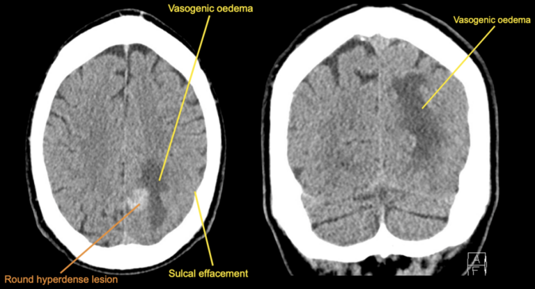 CT Case 001 • LITFL • CT scan interpretation