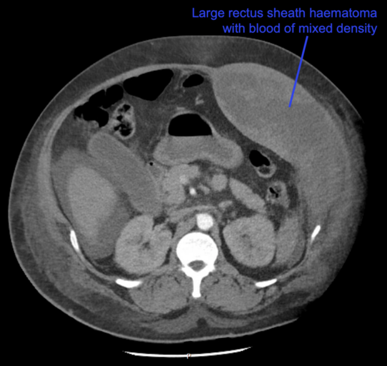 CT Case 003 • LITFL • CT scan interpretation