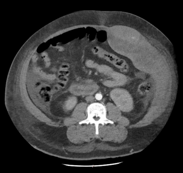 CT Case 003 • LITFL • CT scan interpretation