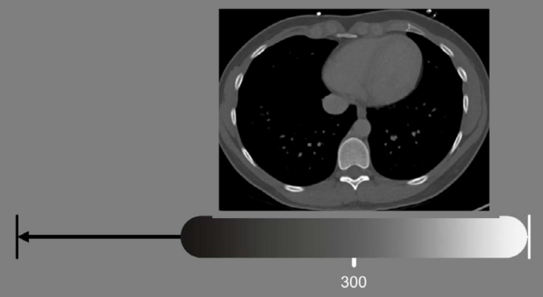 Abdominal CT: Windows advanced • LITFL • Radiology library