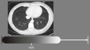 Abdominal CT: Windows advanced • LITFL • Radiology library