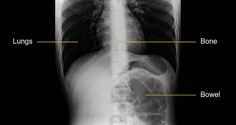 Abdominal CT: Planes • LITFL • Radiology library