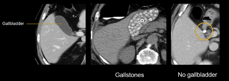 Abdominal CT: Biliary system and Pancreas • LITFL • Radiology