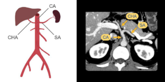 Abdominal CT: abdominal arteries • LITFL • Radiology Library