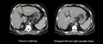 Abdominal CT: Liver • LITFL • Radiology library