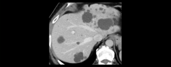 Abdominal Ct Liver Litfl Radiology Library