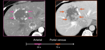 Abdominal CT: Liver • LITFL • Radiology library