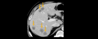 Abdominal CT: Liver • LITFL • Radiology library