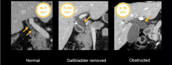 Abdominal CT: Biliary system and Pancreas • LITFL • Radiology