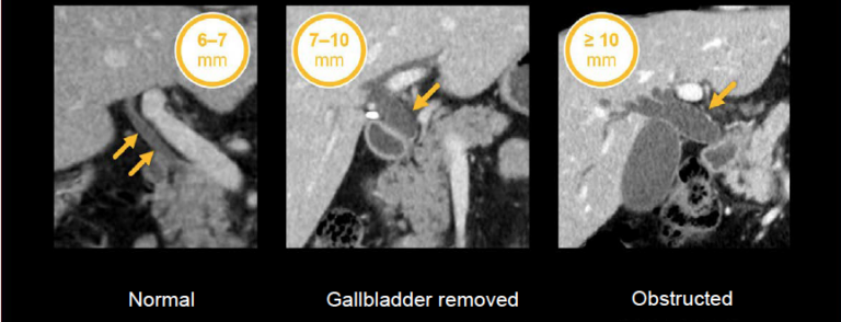 Abdominal CT: Biliary system and Pancreas • LITFL • Radiology