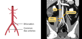Abdominal CT: abdominal arteries • LITFL • Radiology Library