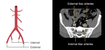 Abdominal CT: abdominal arteries • LITFL • Radiology Library