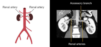 Abdominal CT: abdominal arteries • LITFL • Radiology Library