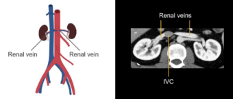 Abdominal CT: abdominal arteries • LITFL • Radiology Library