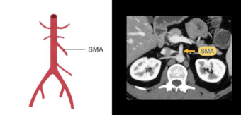 Abdominal CT: abdominal arteries • LITFL • Radiology Library