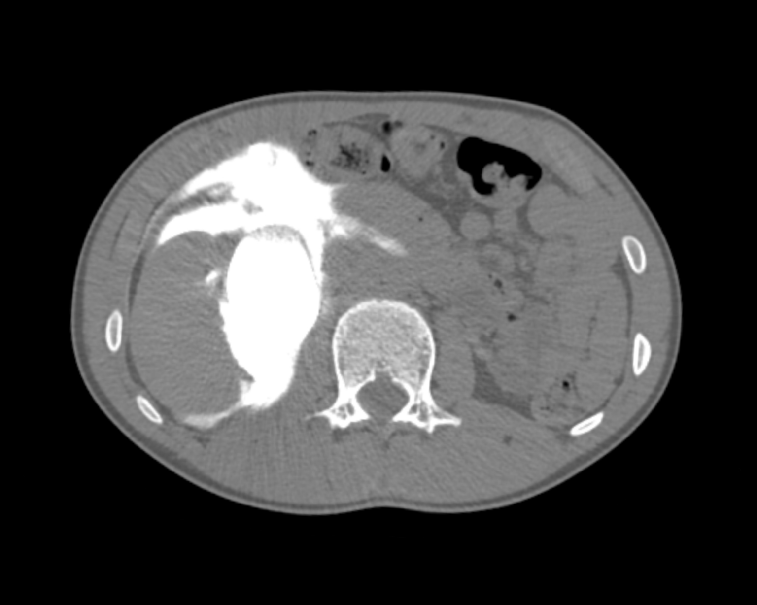 CT Case 043 • LITFL • CT scan interpretation