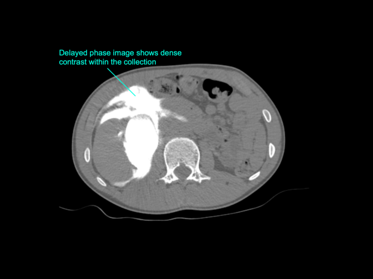 CT Case 043 • LITFL • CT scan interpretation