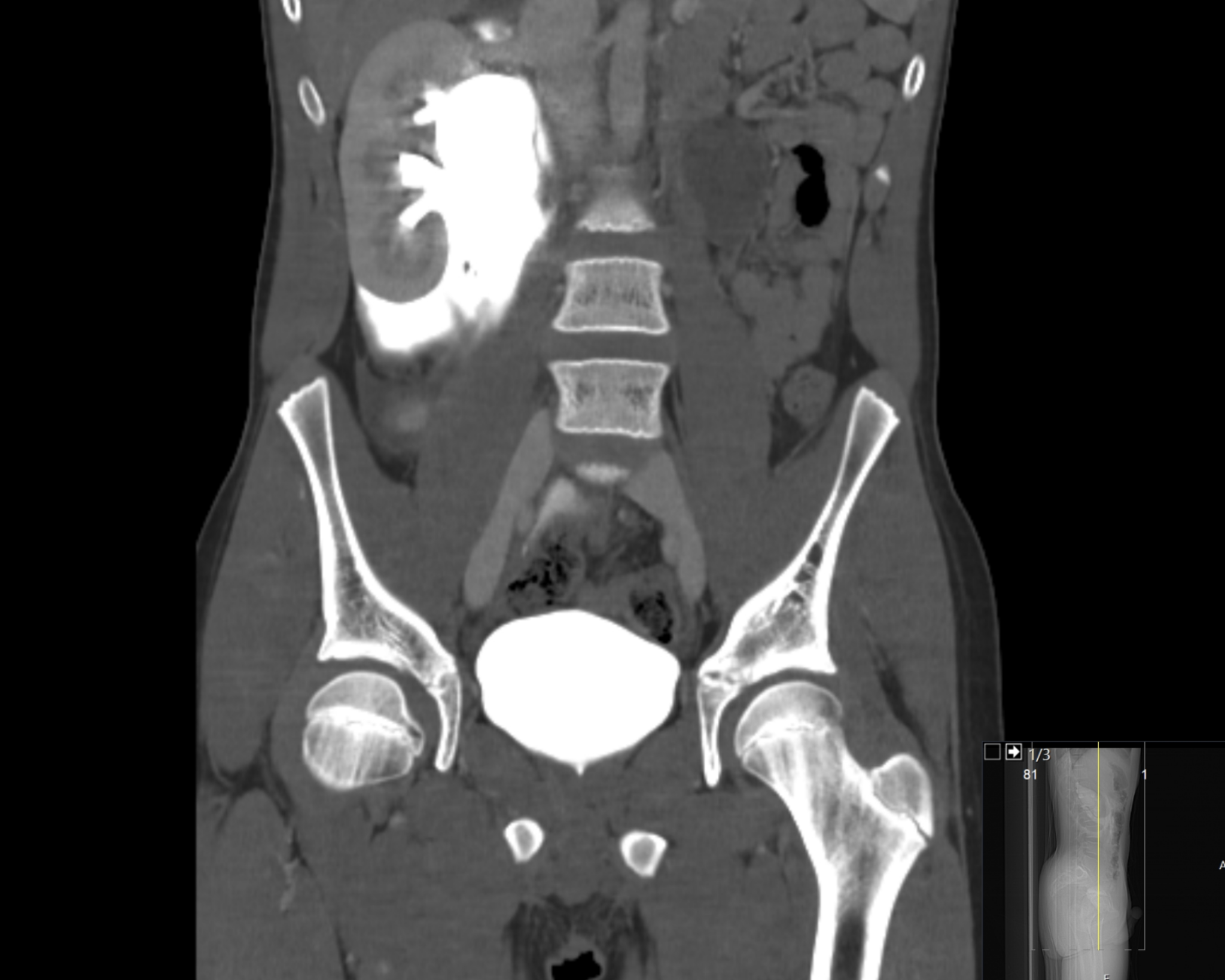 CT Case 043 • LITFL • CT scan interpretation