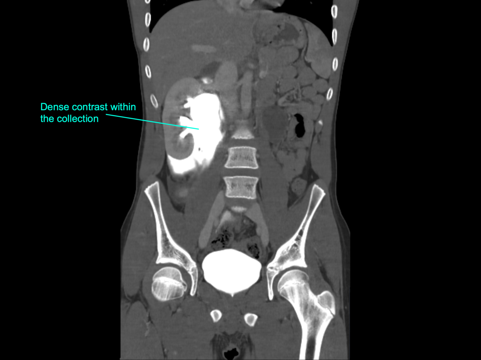 CT Case 043 • LITFL • CT scan interpretation