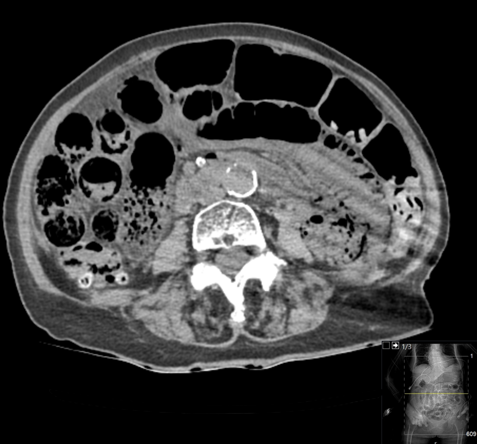 CT Case 045 • LITFL • CT scan interpretation