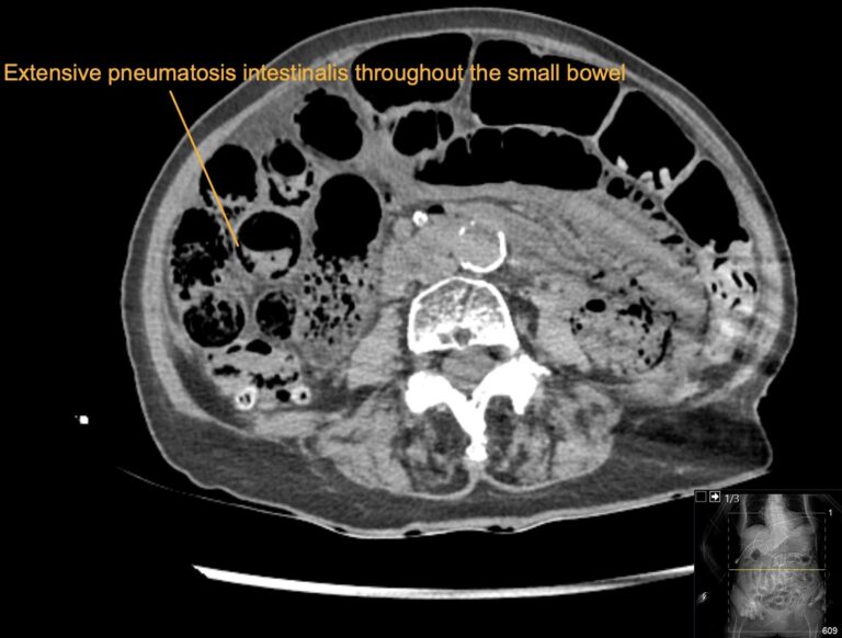 CT Case 045 • LITFL • CT scan interpretation