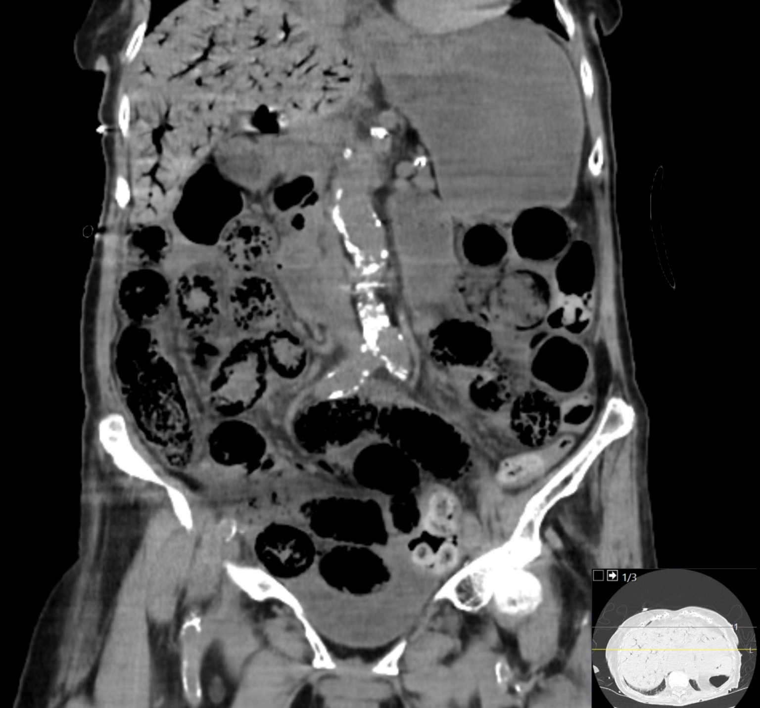CT Case 045 • LITFL • CT scan interpretation