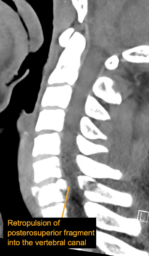 CT Case 049 • LITFL • CT scan interpretation