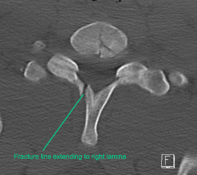 CT Case 049 • LITFL • CT scan interpretation