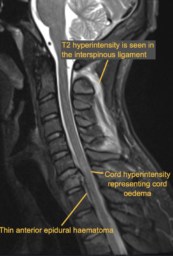 CT Case 049 • LITFL • CT scan interpretation