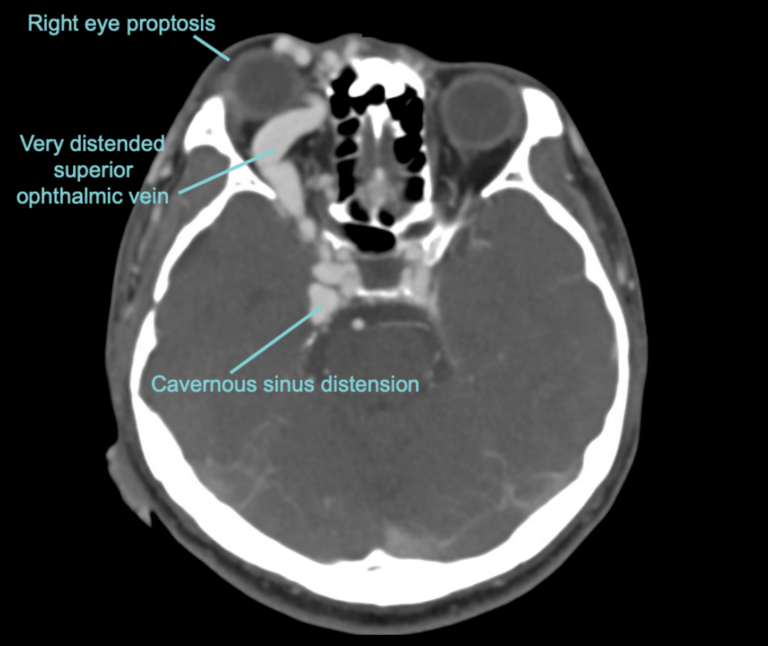CT Case 008 • LITFL • CT scan interpretation