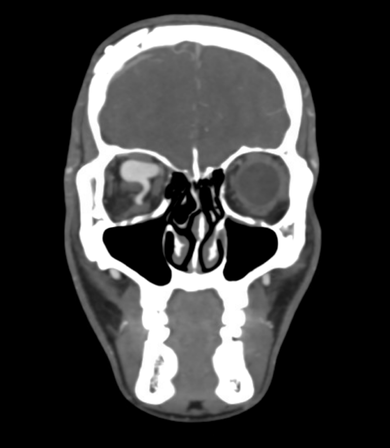 CT Case 008 • LITFL • CT scan interpretation