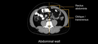 Abdominal CT: body wall • LITFL • Radiology Library