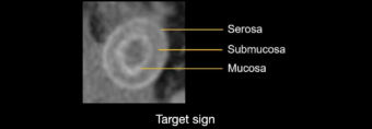 Abdominal CT: enteritis and colitis • LITFL • Radiology Library