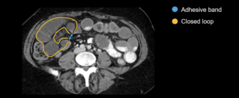 Abdominal CT: closed loop • LITFL • Radiology Library