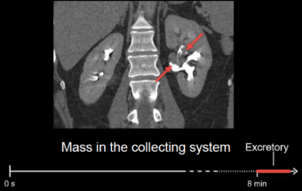 Abdominal CT: Flank pain • LITFL • Radiology library