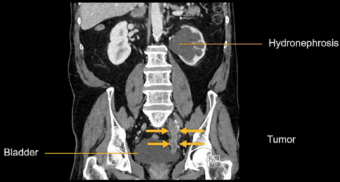 Abdominal CT: Flank pain • LITFL • Radiology library