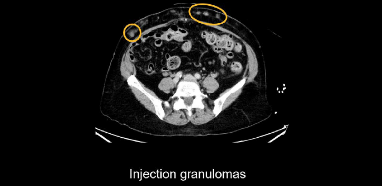 Abdominal CT: body wall • LITFL • Radiology Library